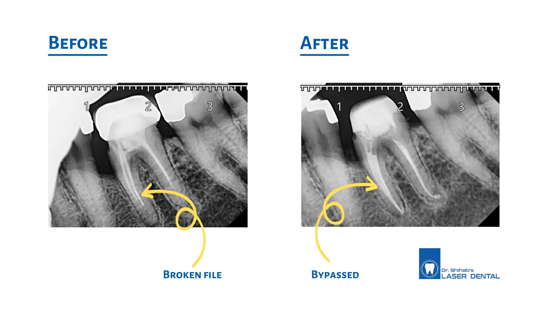 Root Canal Treatment - Best Dental Clinic In Uttara - LASER DENTAL