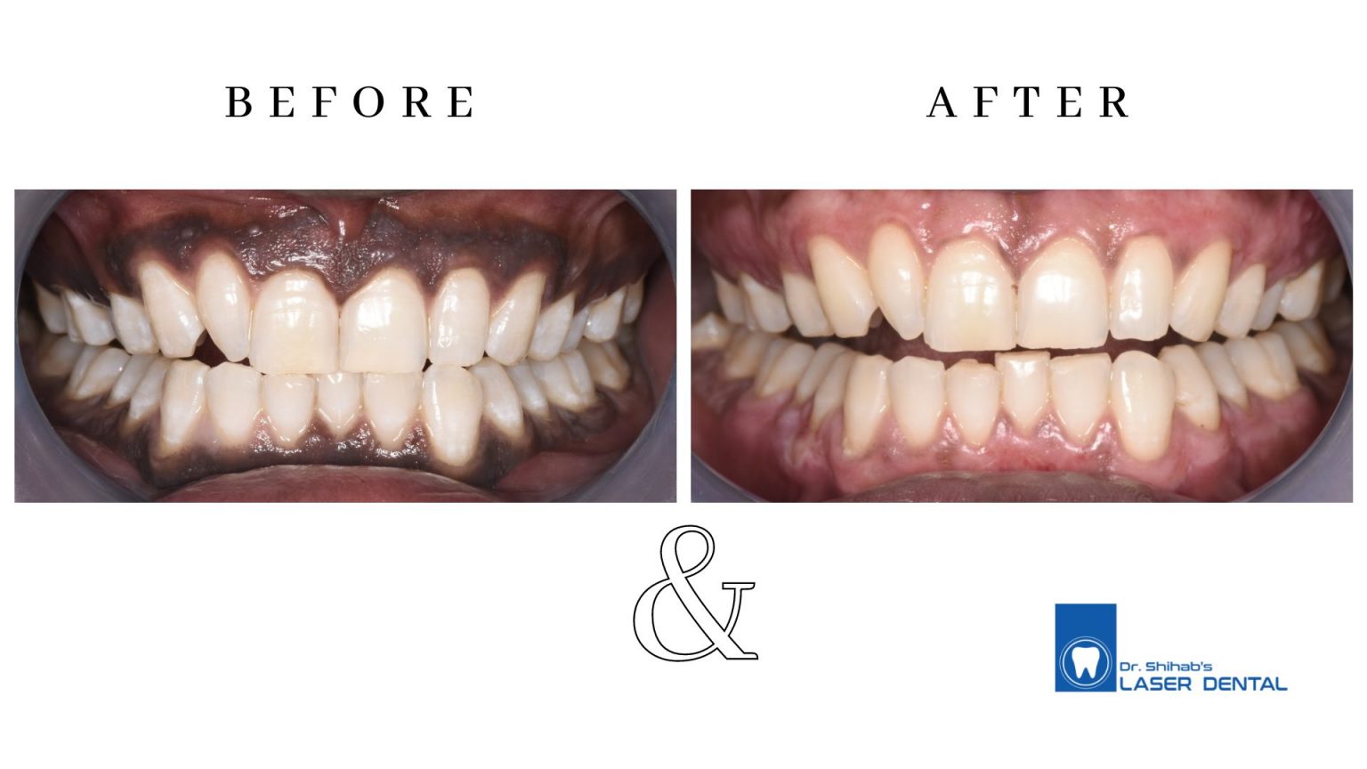 Gum Depigmentation - Best Dental Clinic In Uttara - LASER DENTAL